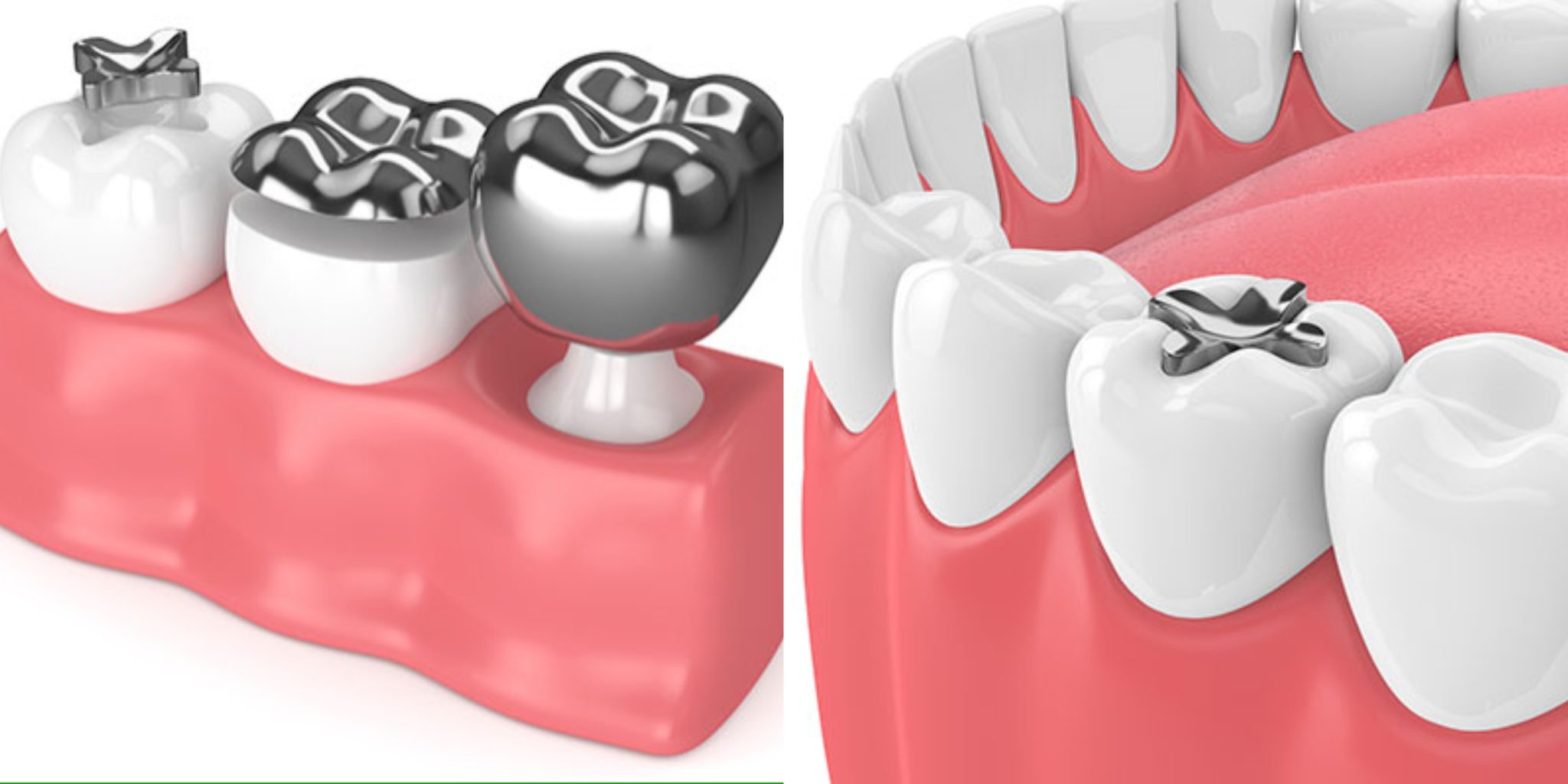 Filling Inlays and Onlays - For Your Smile Dental Calgary